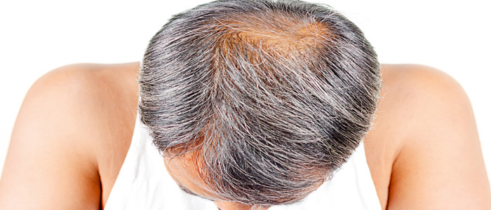 Premature Greying of Hair: Reasons & Treatment