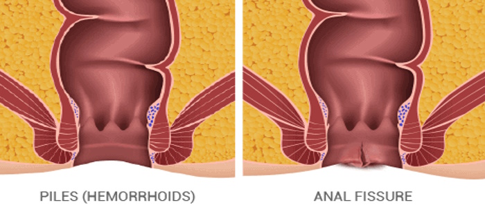 Piles Vs Fissures Understanding The Key Differences